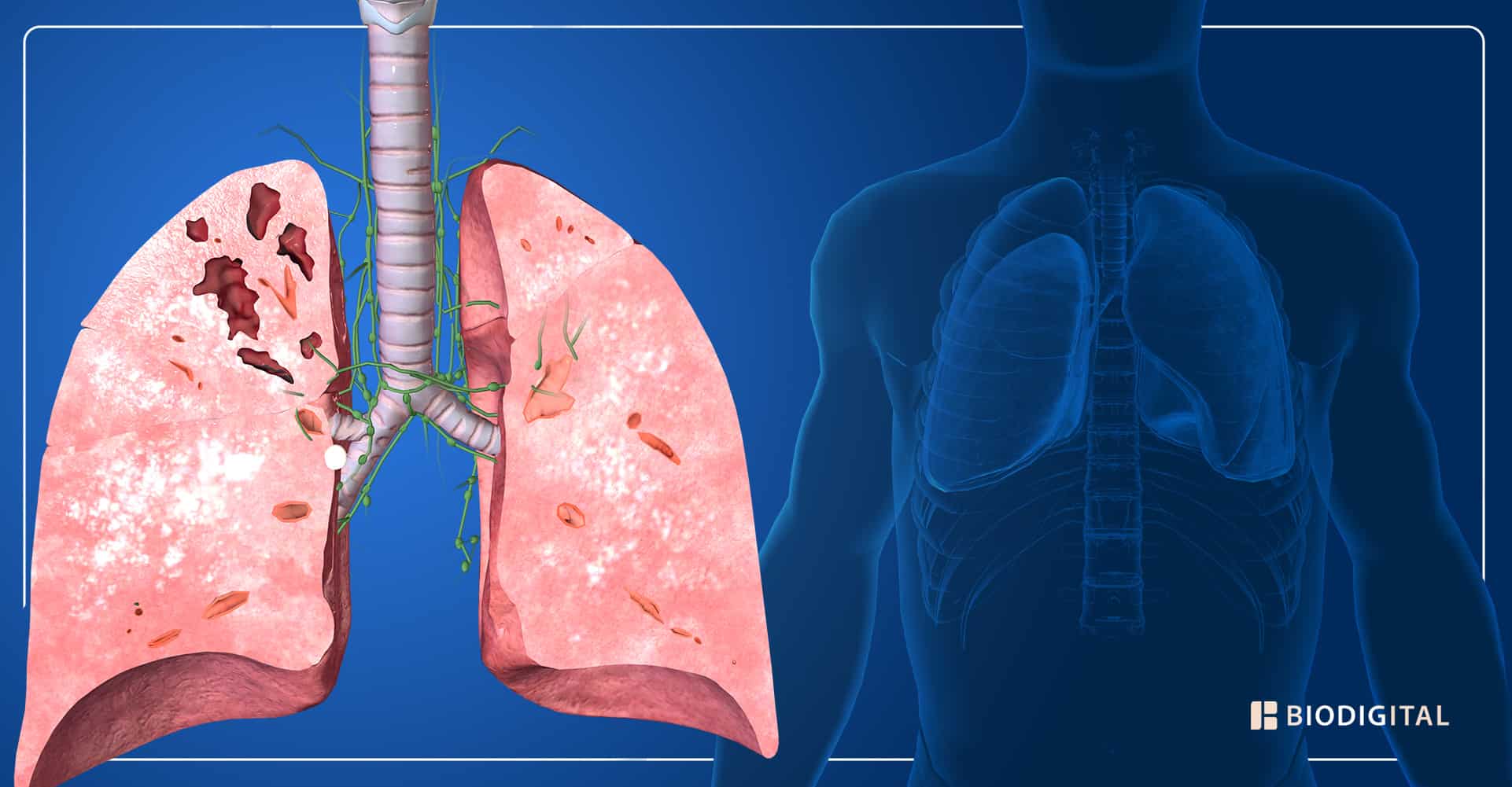 Ano nga ba ang TB, o tuberculosis? Alamin dito