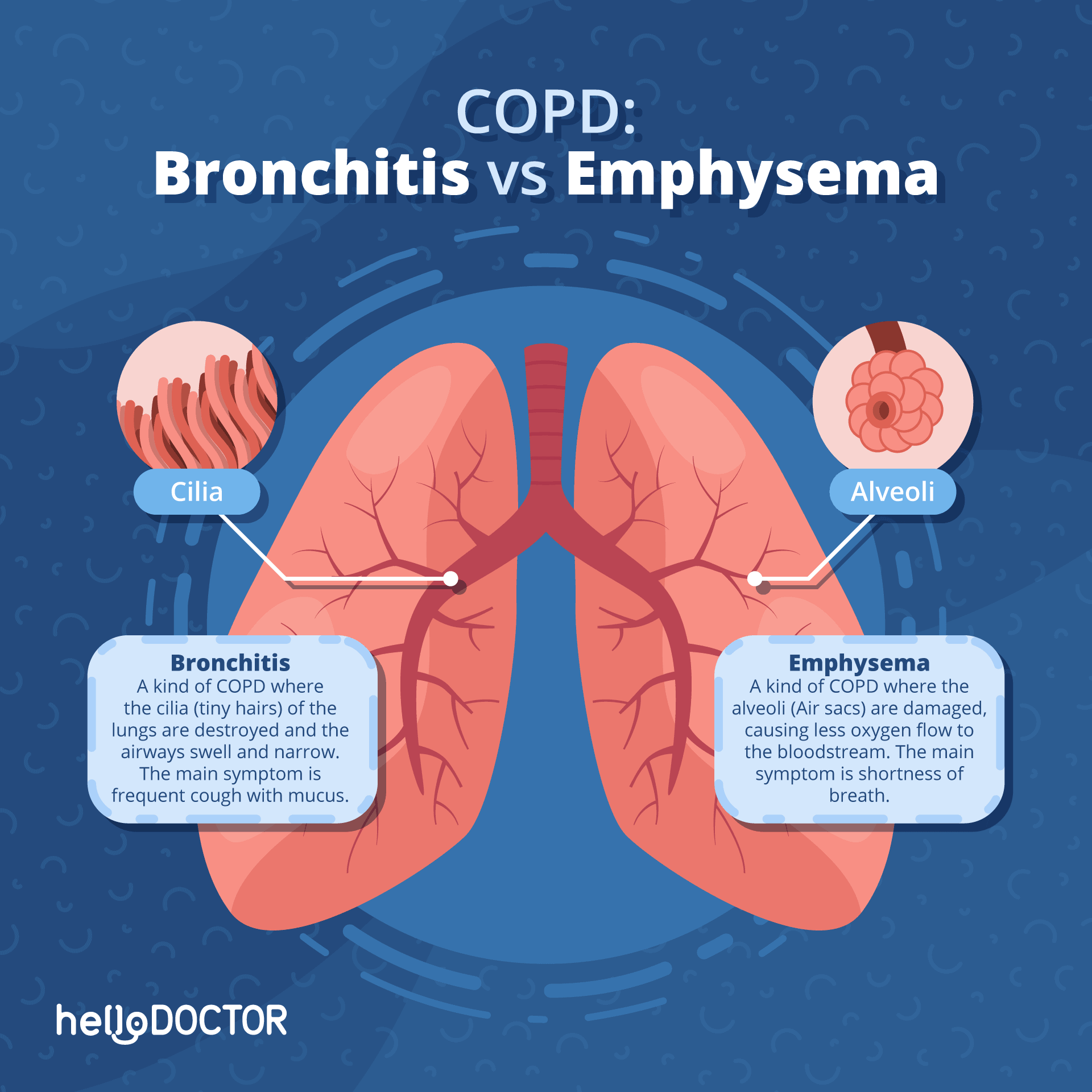 Emphysema Facts: All You Need To Know About This Pulmonary Disease