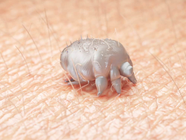 Best Scabies Prevention Tips: Learn What to Do with "Galis"