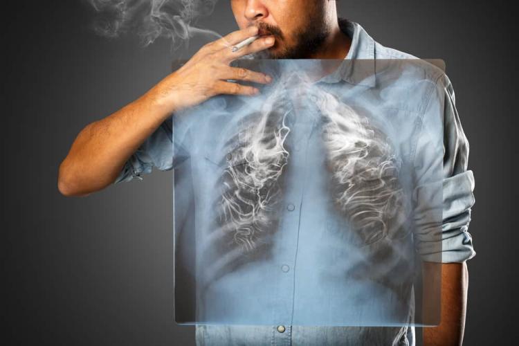 Emphysema Facts: All You Need To Know About This Pulmonary Disease