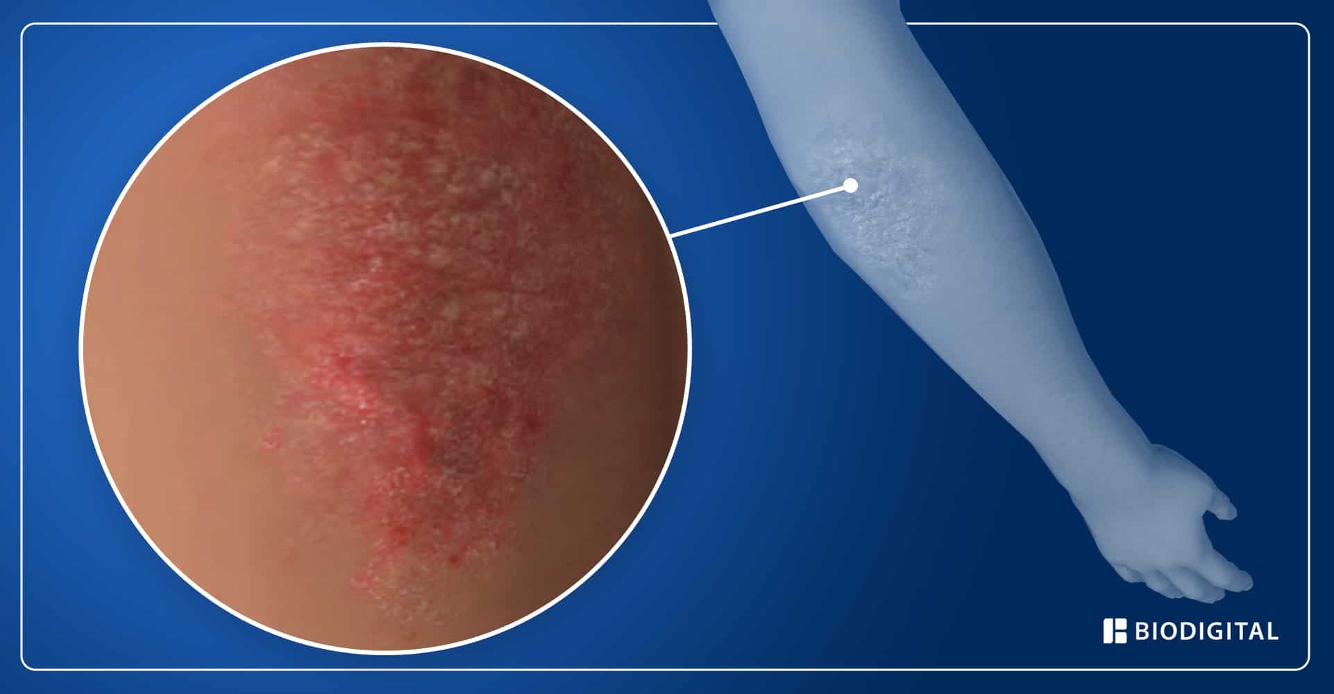 Psoriasis Causes and Cures: All You Need to Know