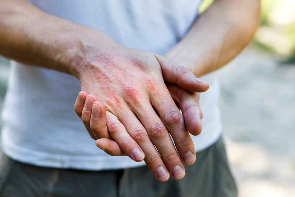 Atopic Dermatitis Causes, Symptoms, and Treatment