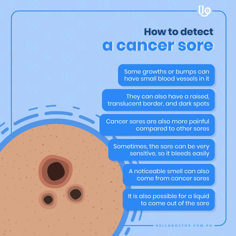 How to Detect a Cancer Sore - What You Need to Know