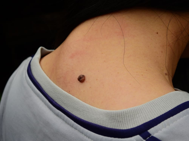 Buhay Na Nunal: Is It Normal Or Should I Worry About It?