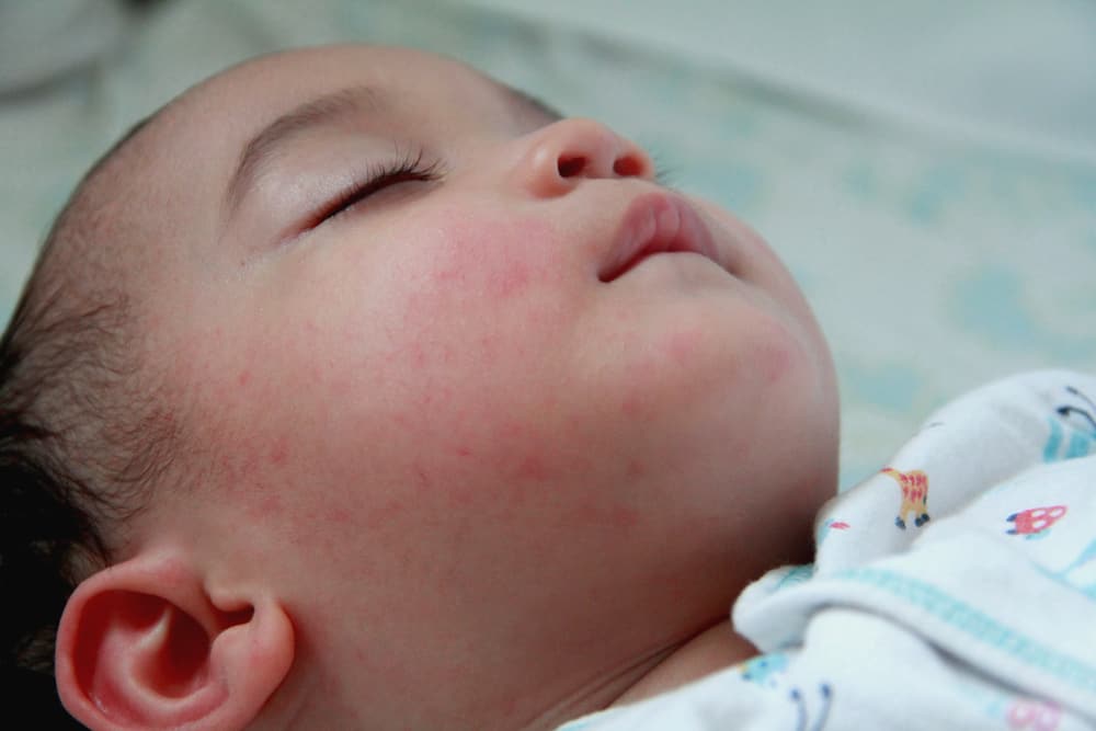 Breast Milk For Rash Treatment: What Do Studies Say About It?