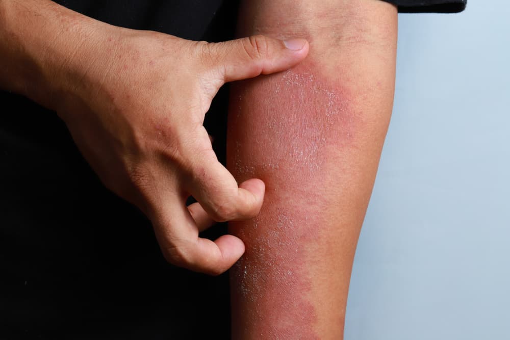 7 Common Types of Skin Rashes in the Philippines