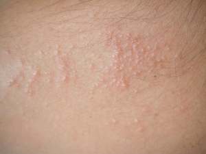 7 Common Types of Skin Rashes in the Philippines