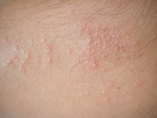 7 Common Types of Skin Rashes in the Philippines