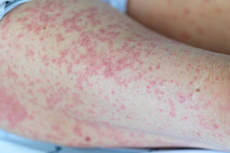 7 Common Types of Skin Rashes in the Philippines