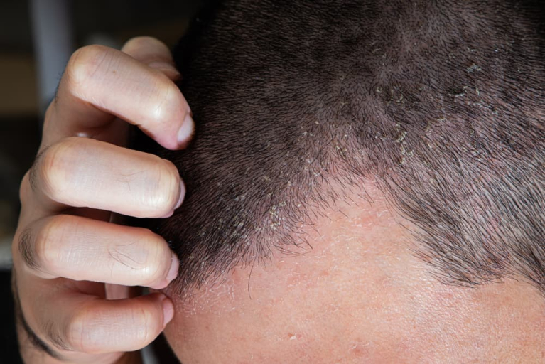 What Causes Seborrheic Dermatitis Flare-Ups? Find Out Here