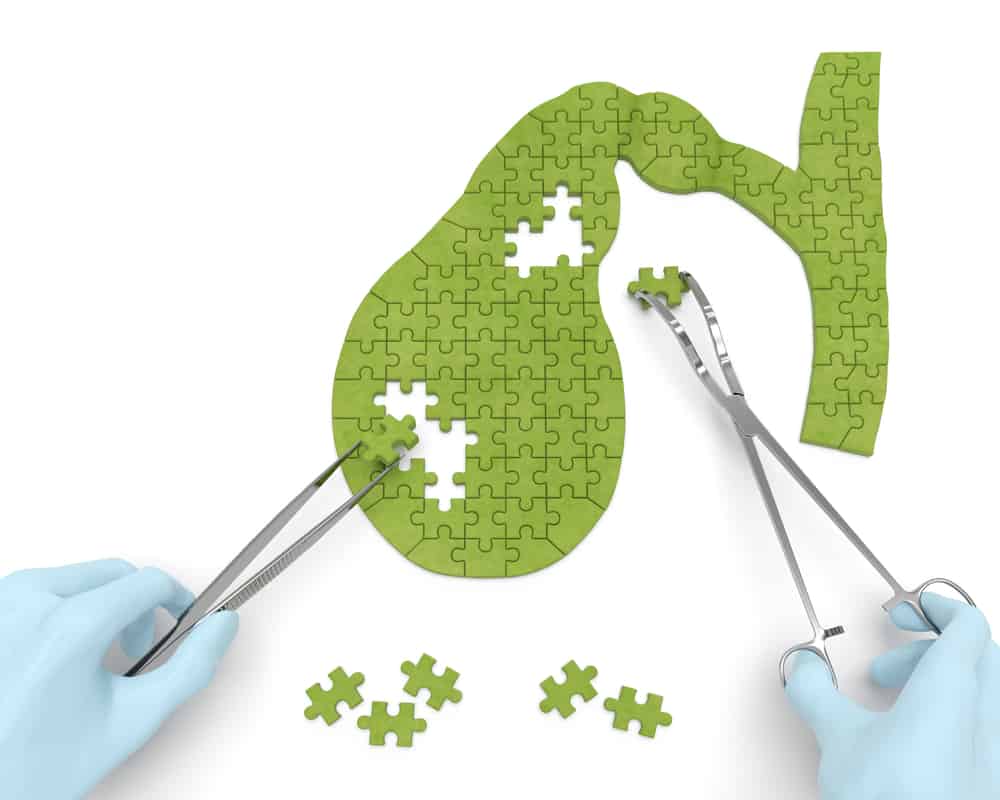 Gallbladder Removal: What Are the Reasons for this Procedure?