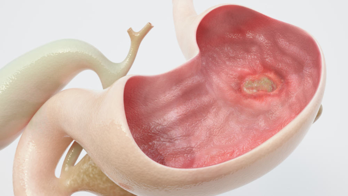 Peptic Ulcer Causes and Types: What You Need to Know