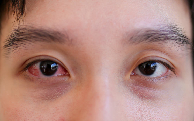 Sore Eyes Causes and Treatment : What You Can Do