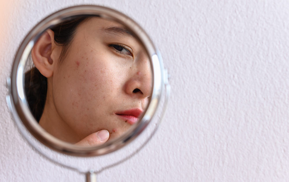 Hormonal Imbalance Effects on Skin: Must Knows for Women
