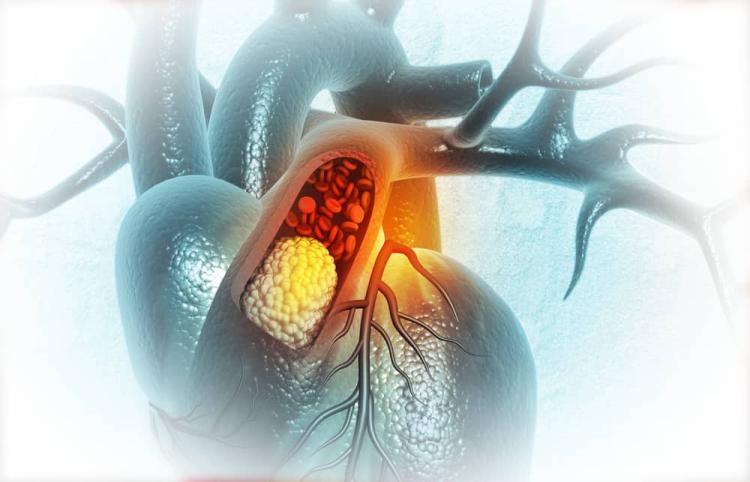 Atherosclerosis of Aorta: Causes, Symptoms, and Prevention