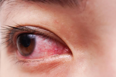 Eye Redness Causes and Treatment : What You Can Do