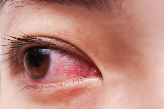 Eye Redness Causes and Treatment : What You Can Do