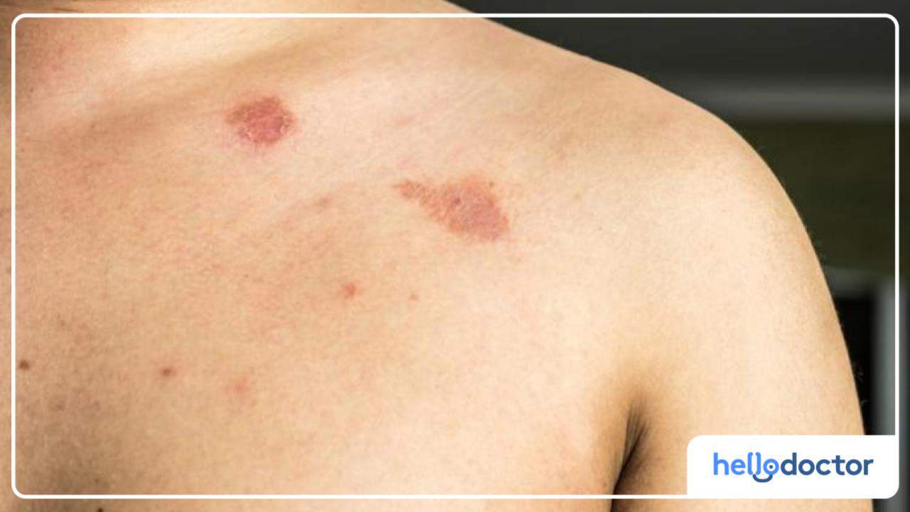 How to Treat Buni?: Home Remedies and Medical Treatment