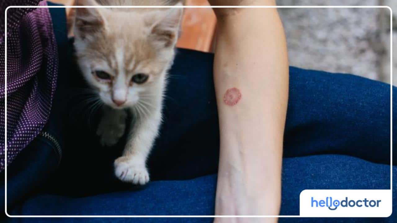 Buni Causes: What You Should Know About Ringworm