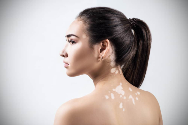Vitiligo Treatment: From Ointments to Skin Depigmentation