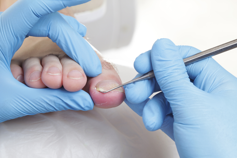 How to Treat an Ingrown Nail: The Dos and Don'ts of Dealing With One