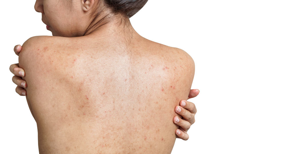 Bacne Causes and Treatment: How to "Cure" Back Acne?