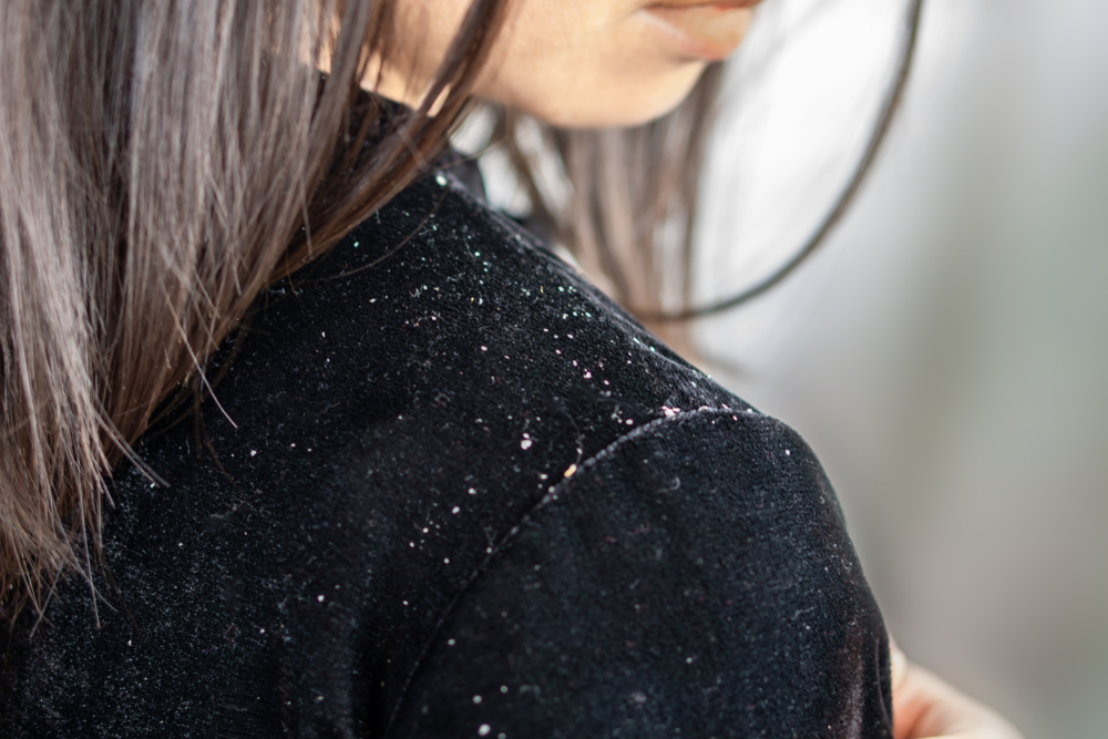 Dandruff Causes: When Should It Become A Cause For Concern?