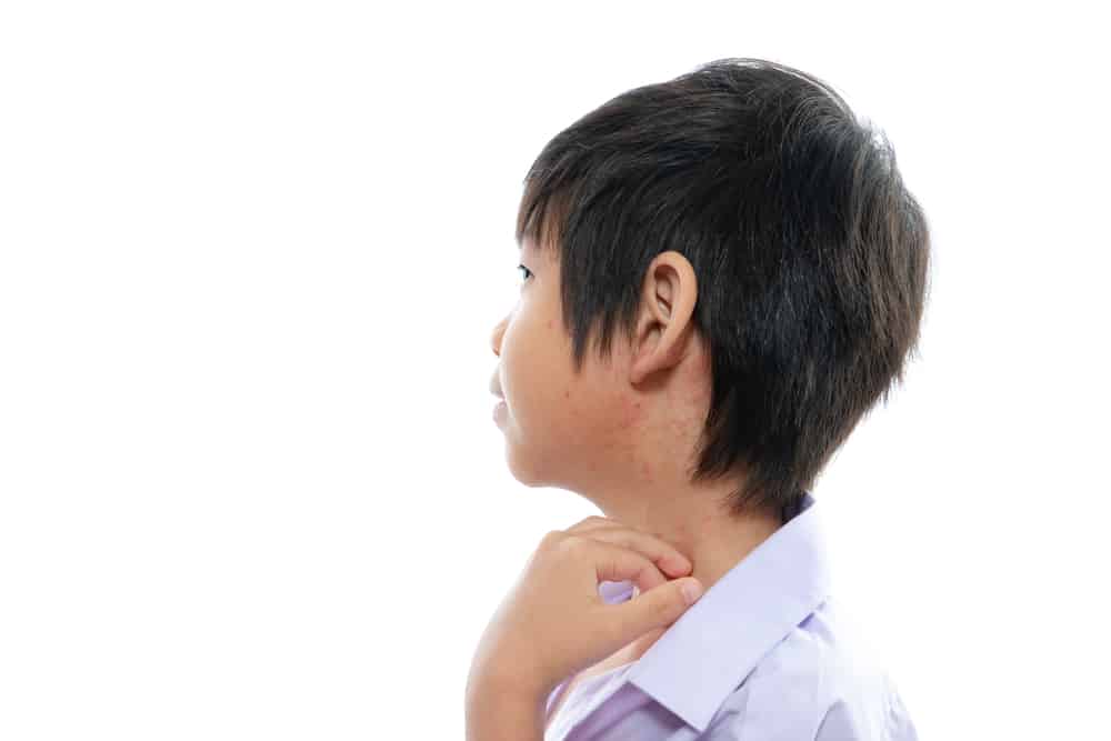 How To Prevent Bungang Araw: 4 Simple Ways To Avoid Prickly Heat Rash