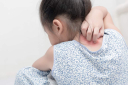 Bungang Araw: 4 Simple and Effective Home Remedies