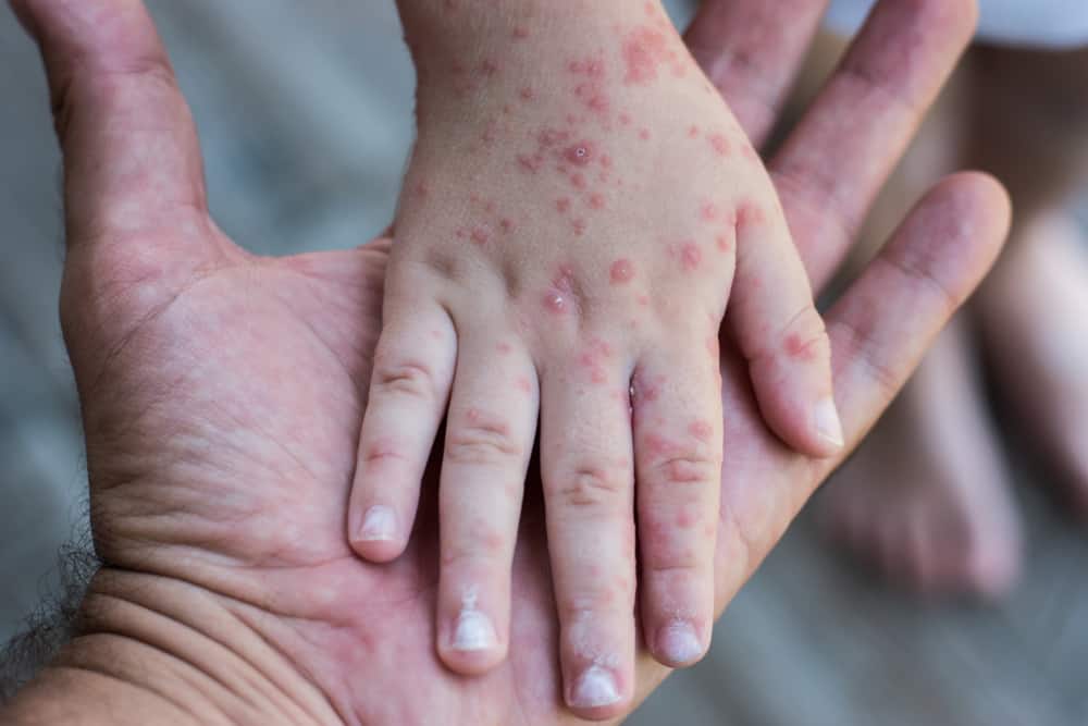 Skin Diseases in Children - Hello Doctor