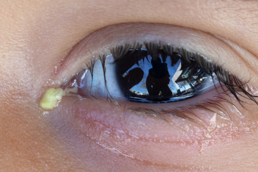 Causes of Eye Discharge and Possible Underlying Conditions