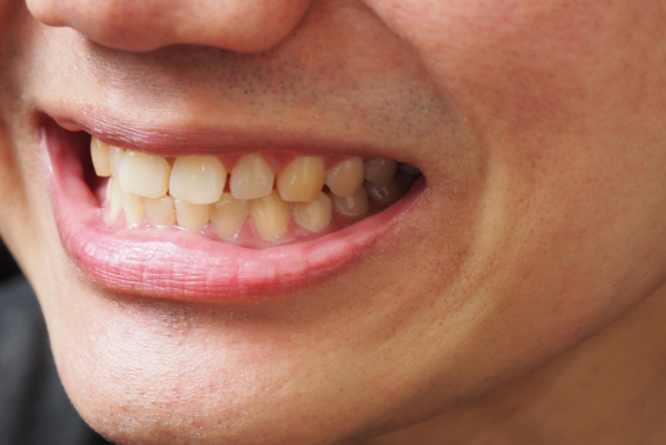 Types of Teeth Stains: What Causes Them and What You Can Do About It