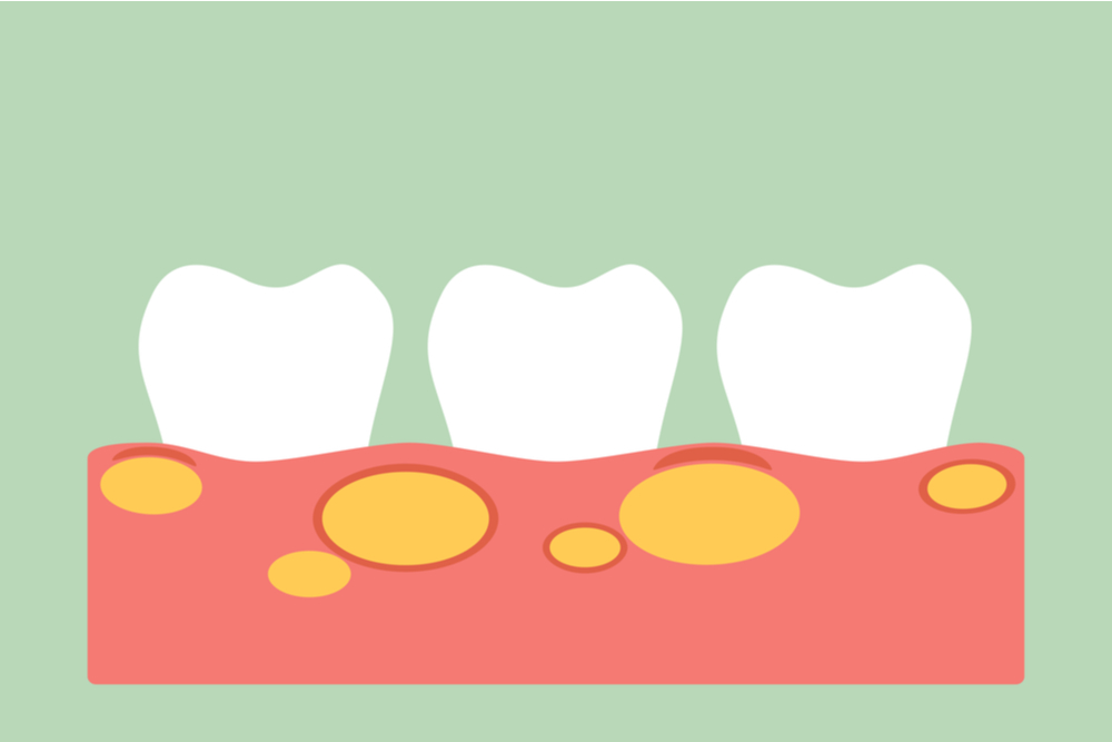 Pus in Gums: What Causes It and How Can You Treat It?