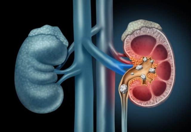 Renal Calculi: Causes, Symptoms, Treatment - Hello Doctor