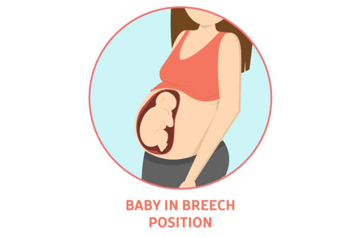 Signs of Breech Baby Delivery Parents Should Know
