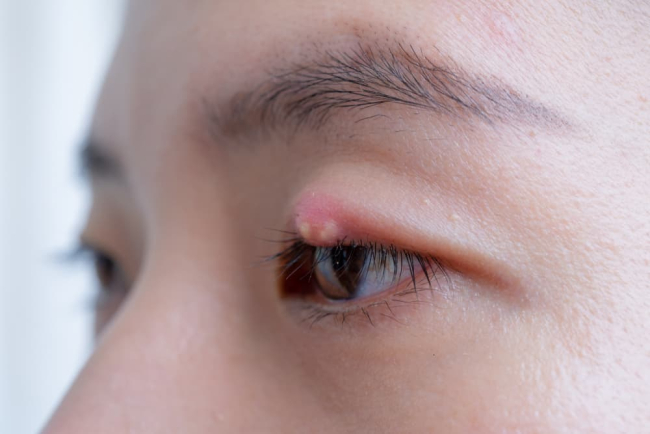 How to Prevent Kuliti (Stye): Make Sure to Observe These Tips