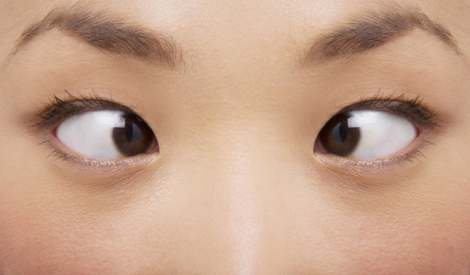 Banlag na Mata at Duling na Mata: What is Strabismus?