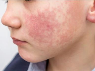 Slapped Cheek Syndrome: Important Facts about This Viral Infection
