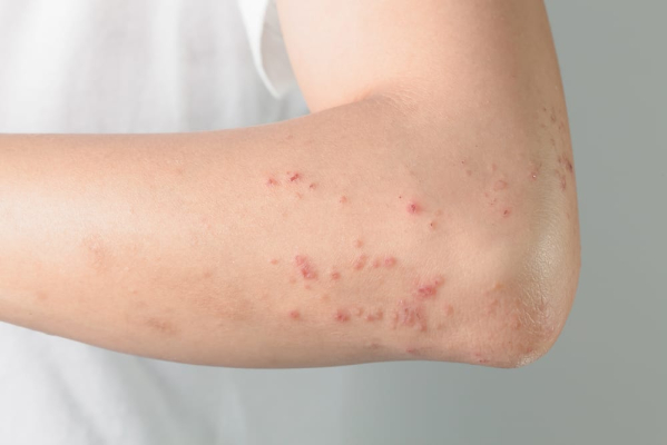Hives Treatment: Here's What You Can Do About Hives