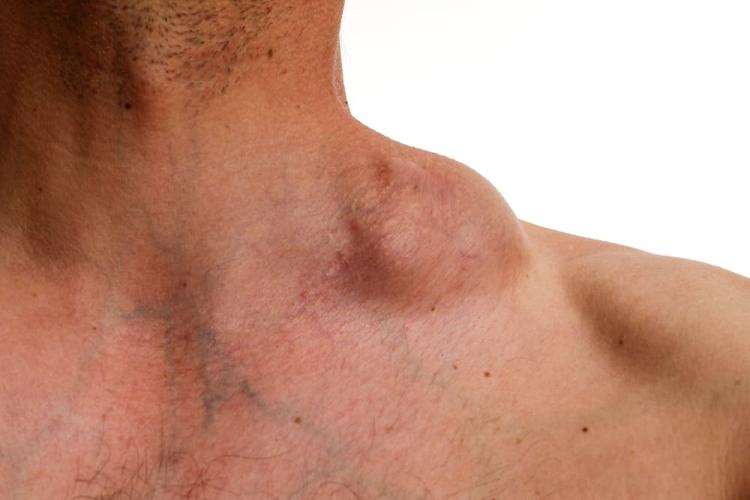 Swollen Lymph Nodes: Are They Signs Of A Serious Condition?