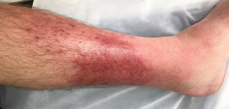 Is Cellulitis Contagious? Here's What You Need to Know