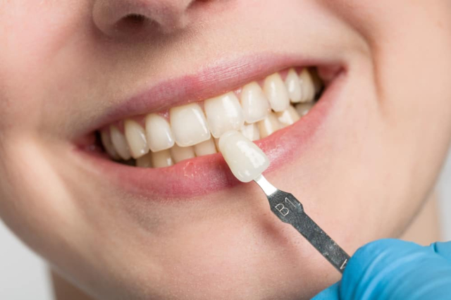 Veneers Teeth Pros and Cons: Are They Good for Your Teeth