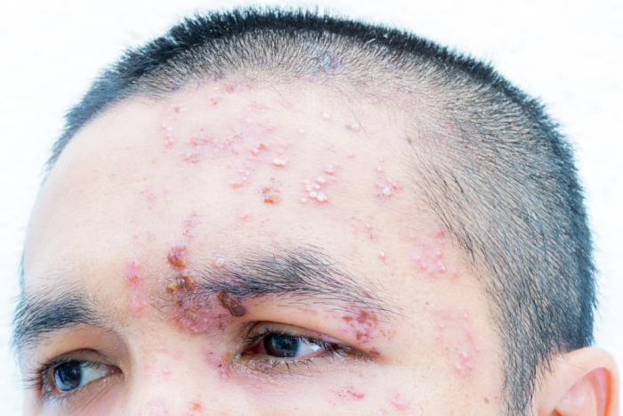 HIV Tongue and Other Telling Signs of HIV/AIDS: The Symptoms to Know