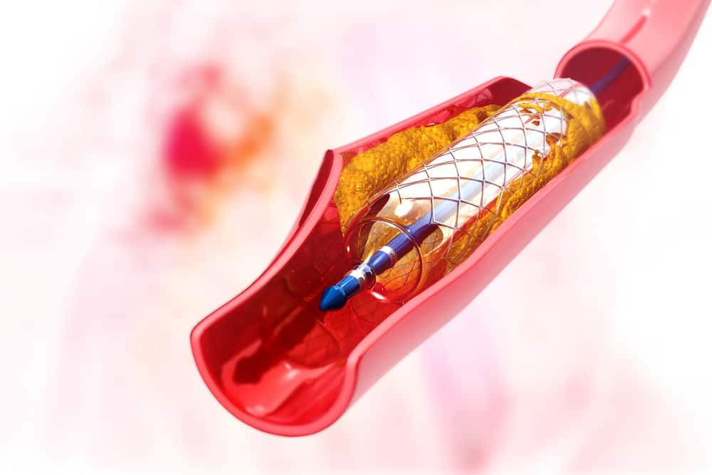 Getting an Angioplasty Surgery? Here's What You Need to Know