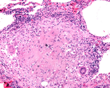 Granuloma in Lungs: When Should I See a Doctor?