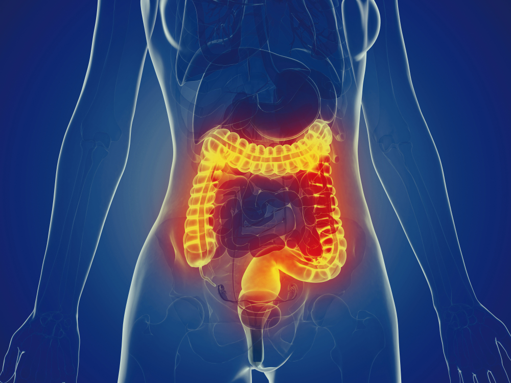 Diverticulitis: What Is It and When Should I See a Doctor?
