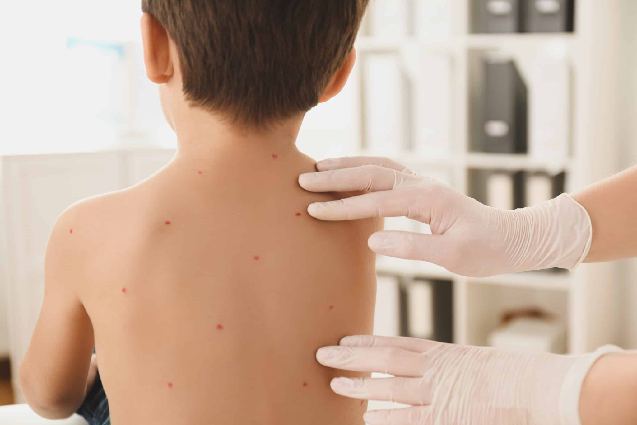 Bulutong Ba Yan? What To Do When You See Chickenpox Rash
