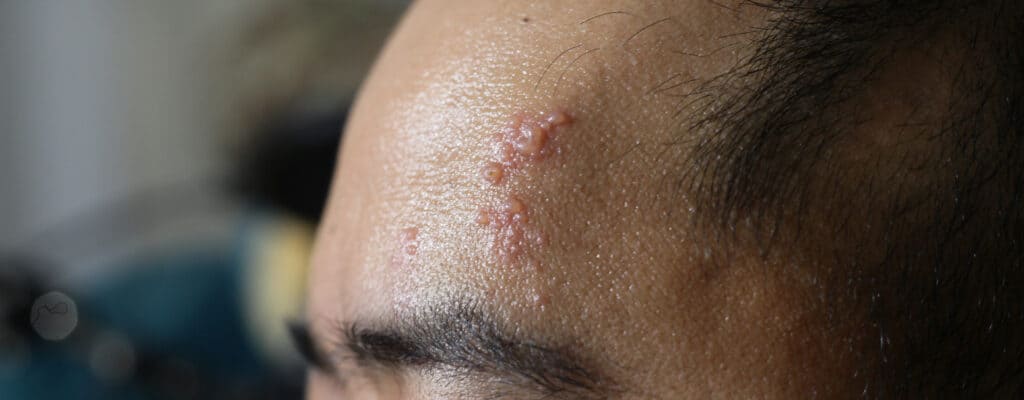 Are Shingles Contagious? Here's Everything You Should Know
