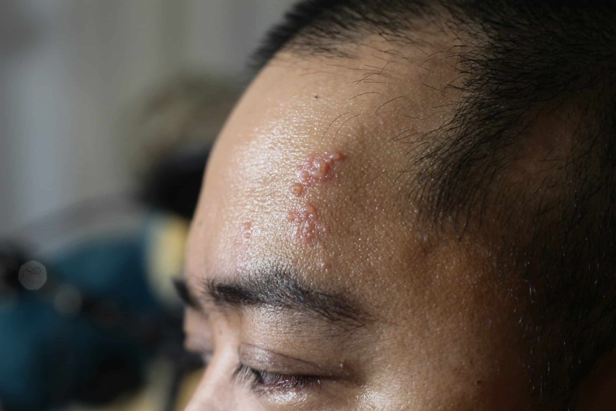 Are Shingles Contagious? Here's Everything You Should Know