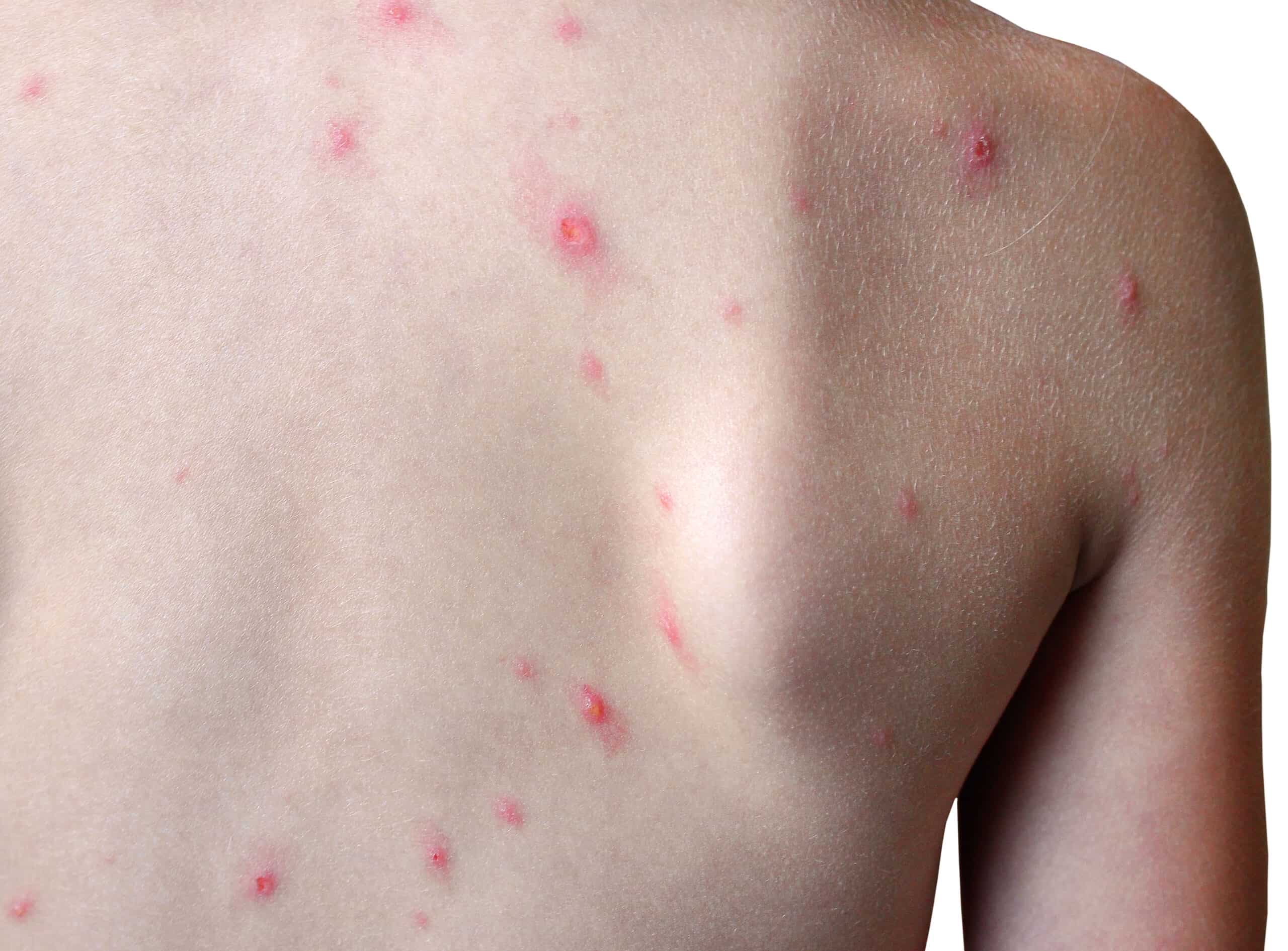 Other Viral Infections - Hello Doctor - Page 1 of 1